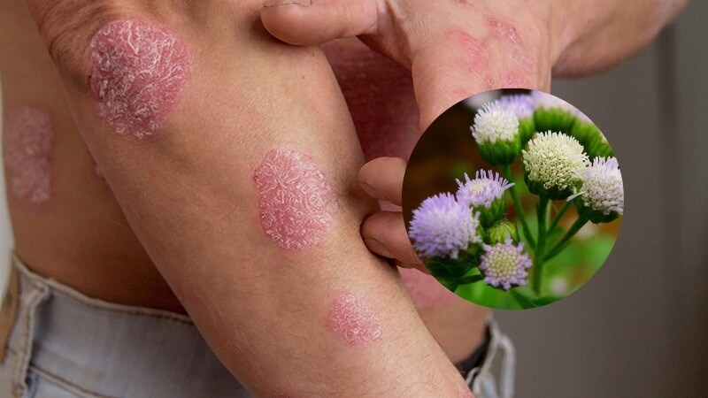 Hoa cứt lợn: 16 tác dụng và cách chữa viêm xoang an toàn