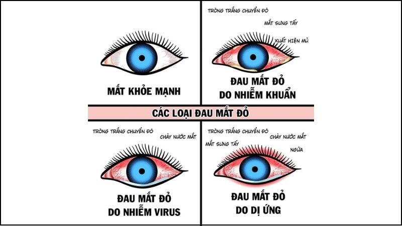 Đau mắt đỏ kiêng gì ăn gì để nhanh khỏi và lưu ý khi chăm sóc mắt