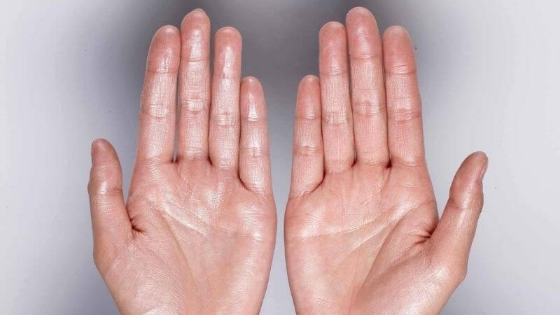 Đổ mồ hôi nhiều là bệnh gì? Nguyên nhân, cách điều trị