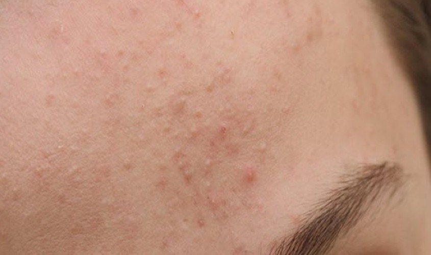 Cách Xử Lý Khi Da Breakout Vì Đổi Mỹ Phẩm Mới – Mỹ Phẩm BENEW