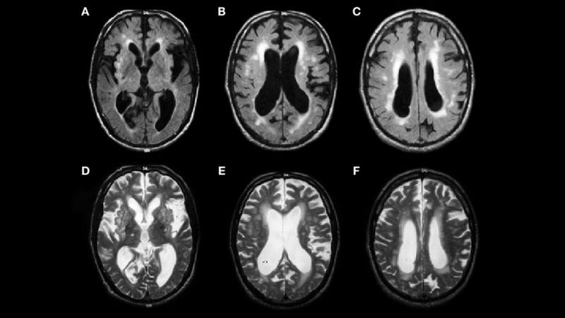Run chân tay là bệnh gì? Nguyên nhân và các biện pháp khắc phục