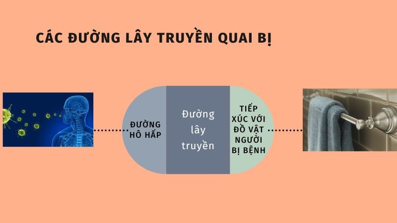 Bệnh quai bị: Nguyên nhân, triệu chứng và cách điều trị