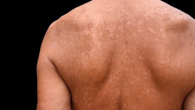 Bộ sưu tập hình ảnh bệnh lang beng để tìm hiểu và nhận biết