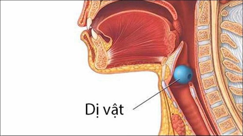 Dị vật rơi vào đường thở: Dấu hiệu nhận biết và cách xử trí kịp thời