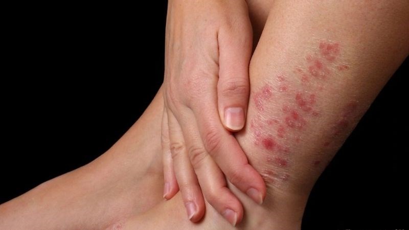 Thượng Mã Phong Là Bệnh Gì? Nguyên Nhân, Triệu Chứng và Cách Phòng Ngừa