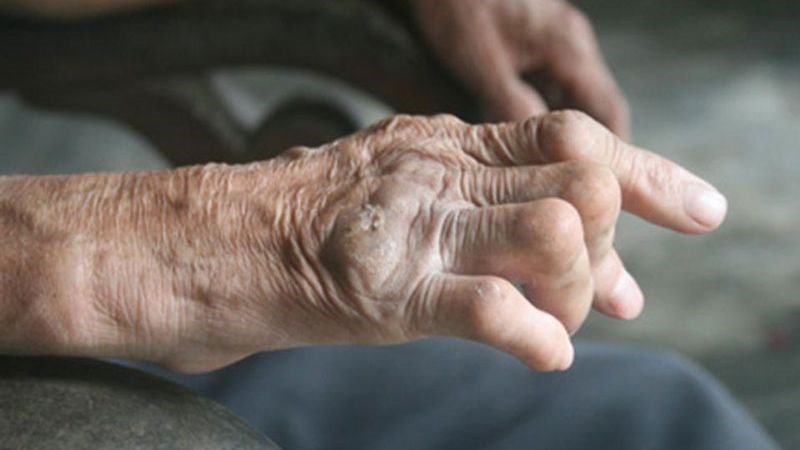 Bệnh phong: Nguyên nhân, triệu chứng và cách điều trị