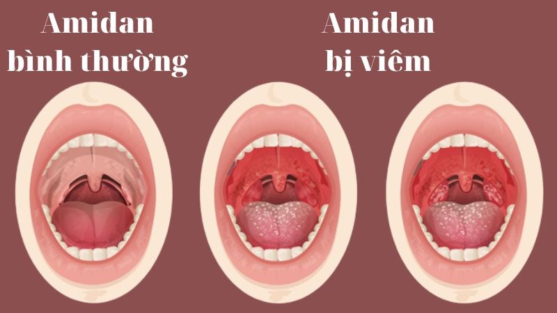 Đau Amidan Nên Làm Gì? Những Cách Hiệu Quả Giảm Đau Và Điều Trị