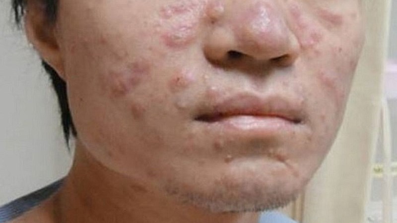 6 triệu chứng u mềm lây cần lưu ý để phát hiện bệnh sớm