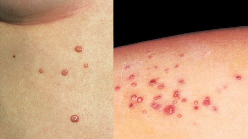 6 triệu chứng u mềm lây cần lưu ý để phát hiện bệnh sớm