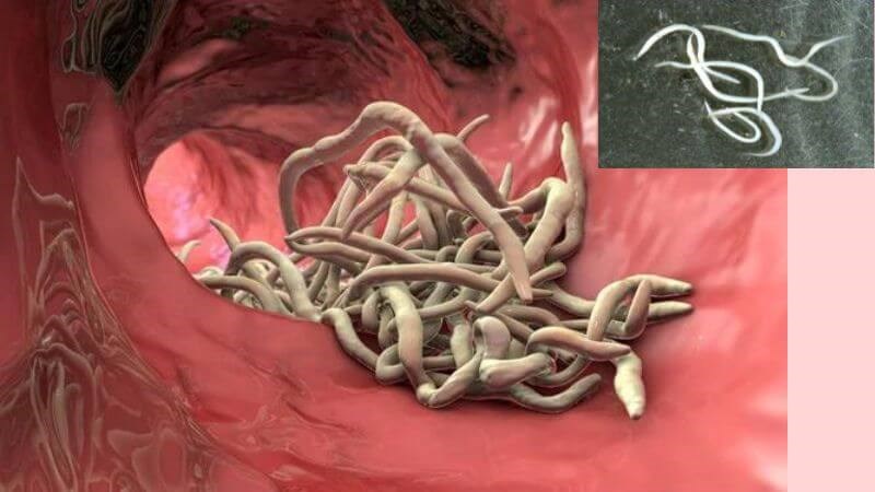 Người nhiễm giun kim sẽ bị gì? 4 dấu hiệu nhiễm giun kim bạn cần biết