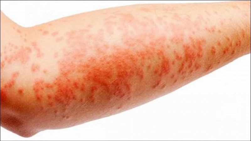 13 nguyên nhân phát ban da và cách khắc phục bạn cần nên biết