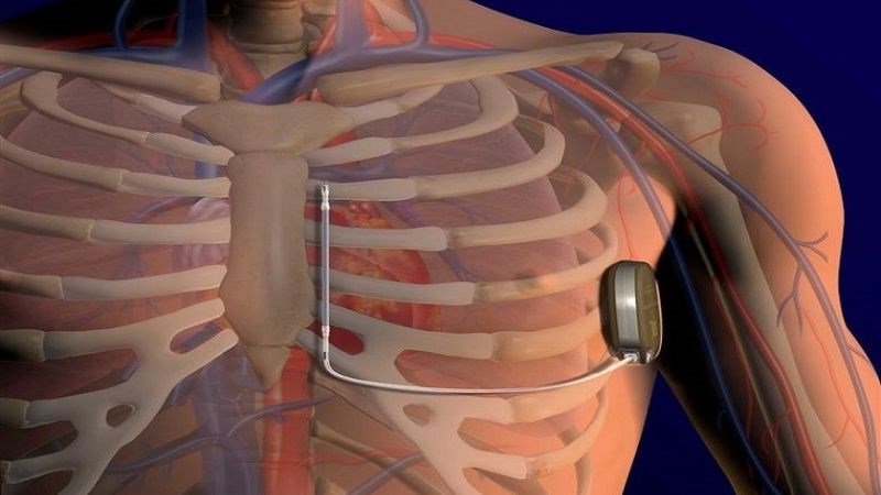 Ngừng tim đột ngột: Nguyên nhân và cách cấp cứu, điều trị
