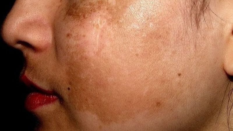 Rám má: Nguyên nhân, dấu hiệu và cách điều trị hiệu quả