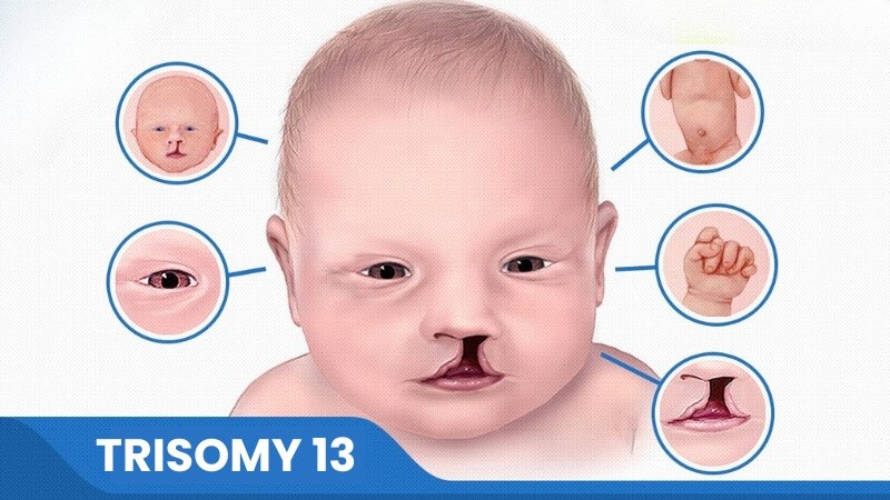 Hội chứng Patau: Nguyên nhân, triệu chứng và cách điều trị