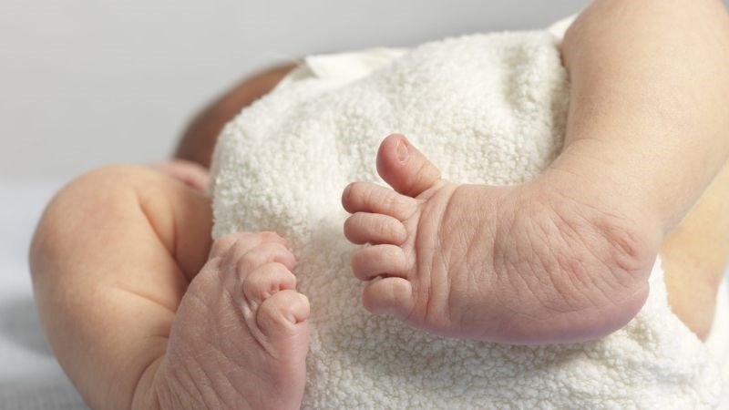 Bàn chân khoèo: Nguyên nhân, dấu hiệu và cách điều trị hiệu quả