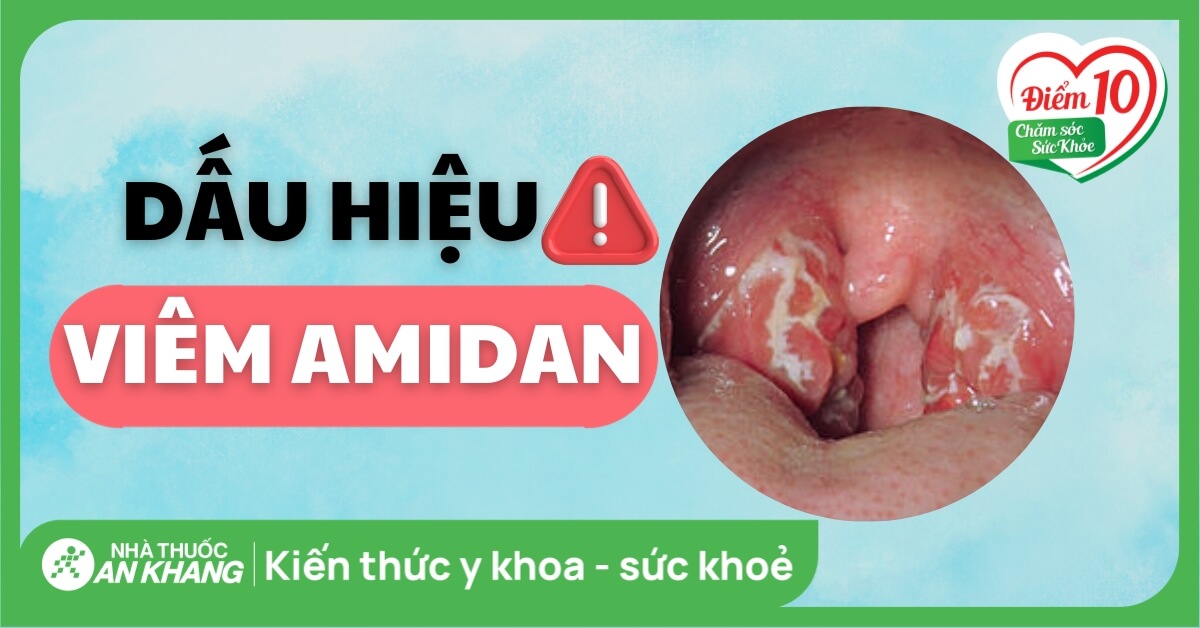 Các dấu hiệu viêm amidan để nhận biết sớm bạn cần lưu ý!