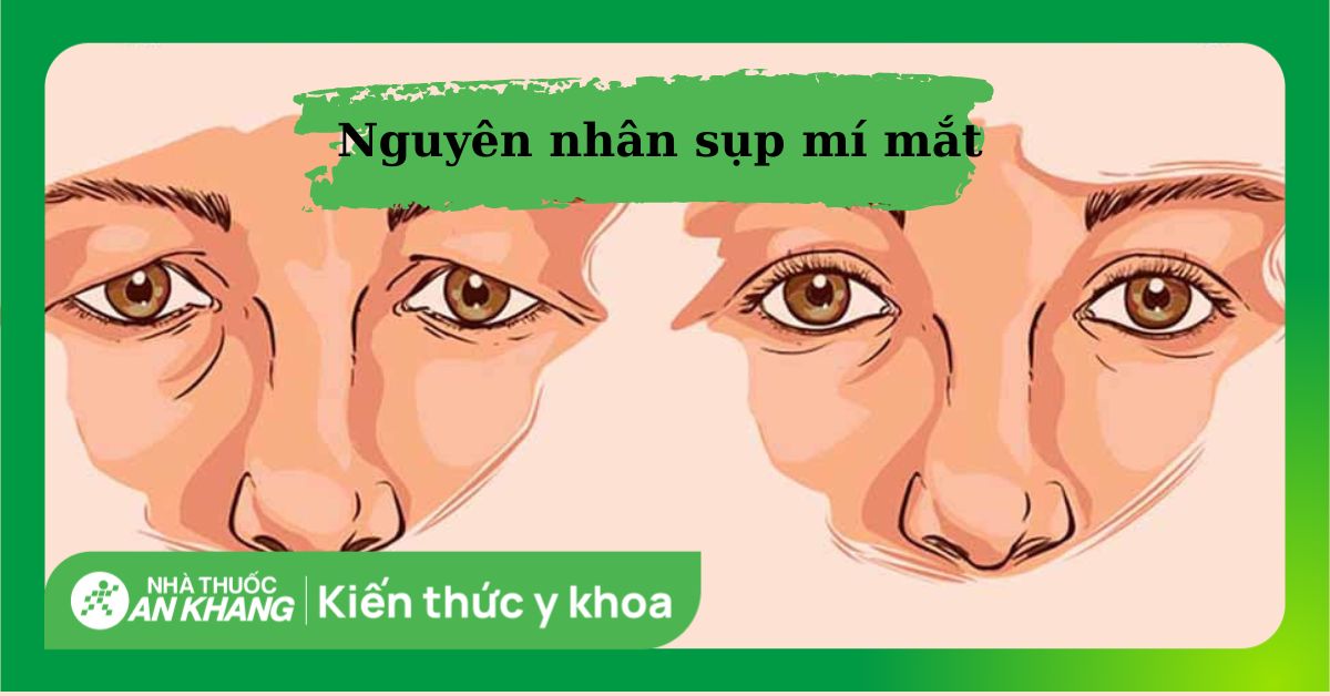 15 nguyên nhân sụp mí mắt và phương pháp khắc phục hiệu quả