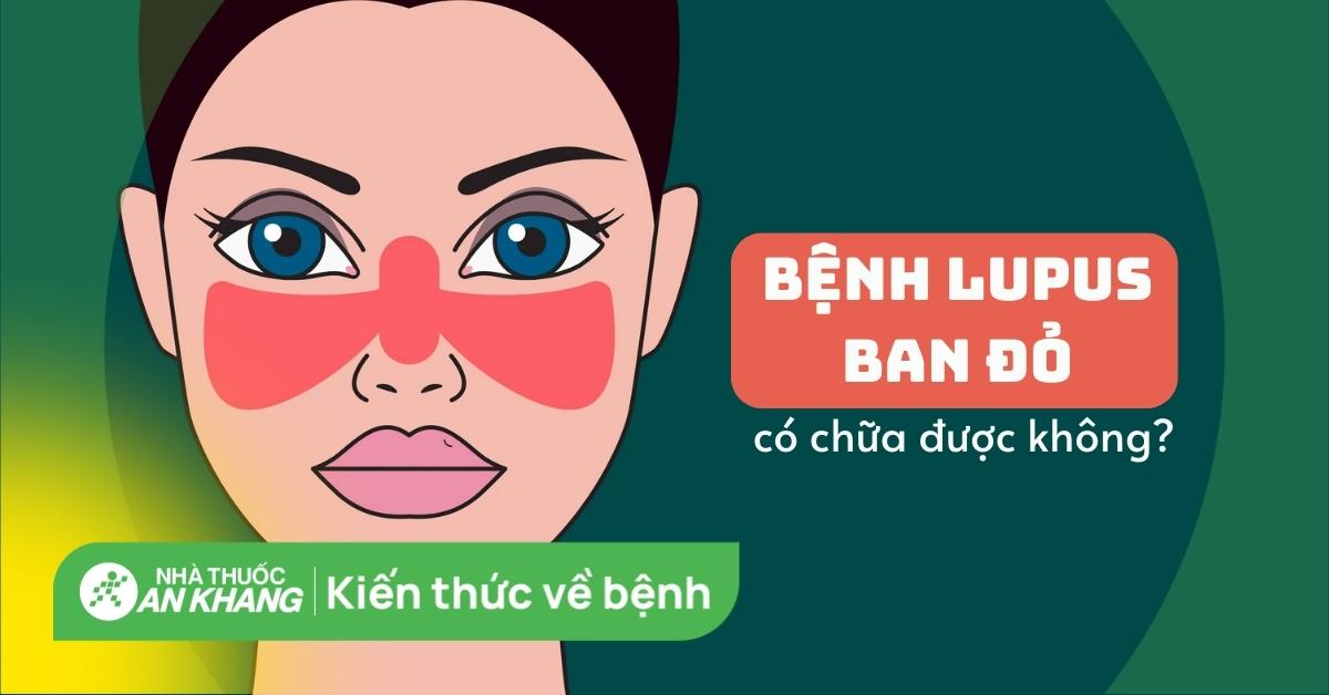 Bệnh lupus ban đỏ có chữa được không? Cách điều trị lupus ban đỏ