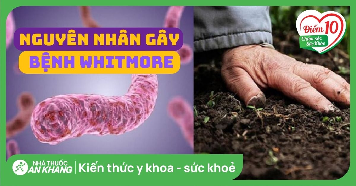 Tìm hiểu các nguyên nhân gây ra bệnh Whitmore