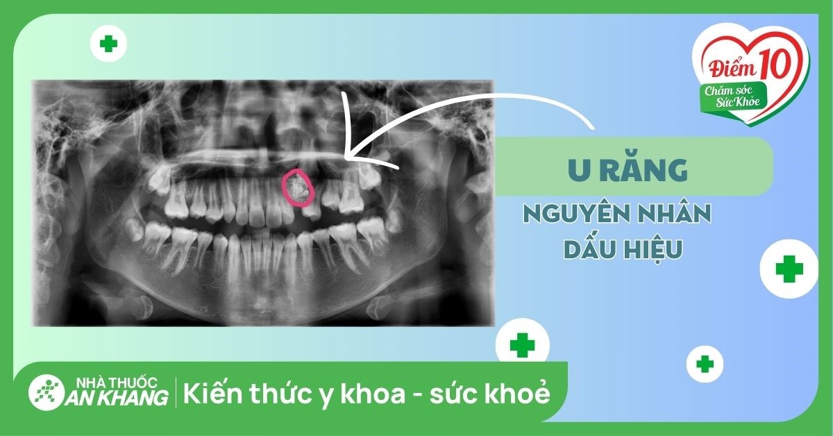 U răng (Odontoma): Nguyên nhân, dấu hiệu và cách điều trị