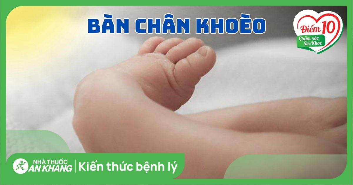 Bàn chân khoèo: Nguyên nhân, dấu hiệu và cách điều trị hiệu quả