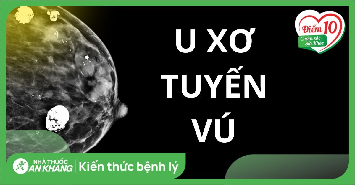 U xơ tuyến vú: Nguyên nhân, triệu chứng và cách điều trị