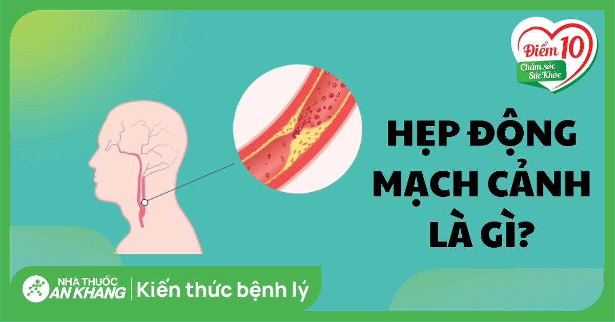 Hẹp động mạch cảnh: Nguyên nhân, triệu chứng và cách điều trị
