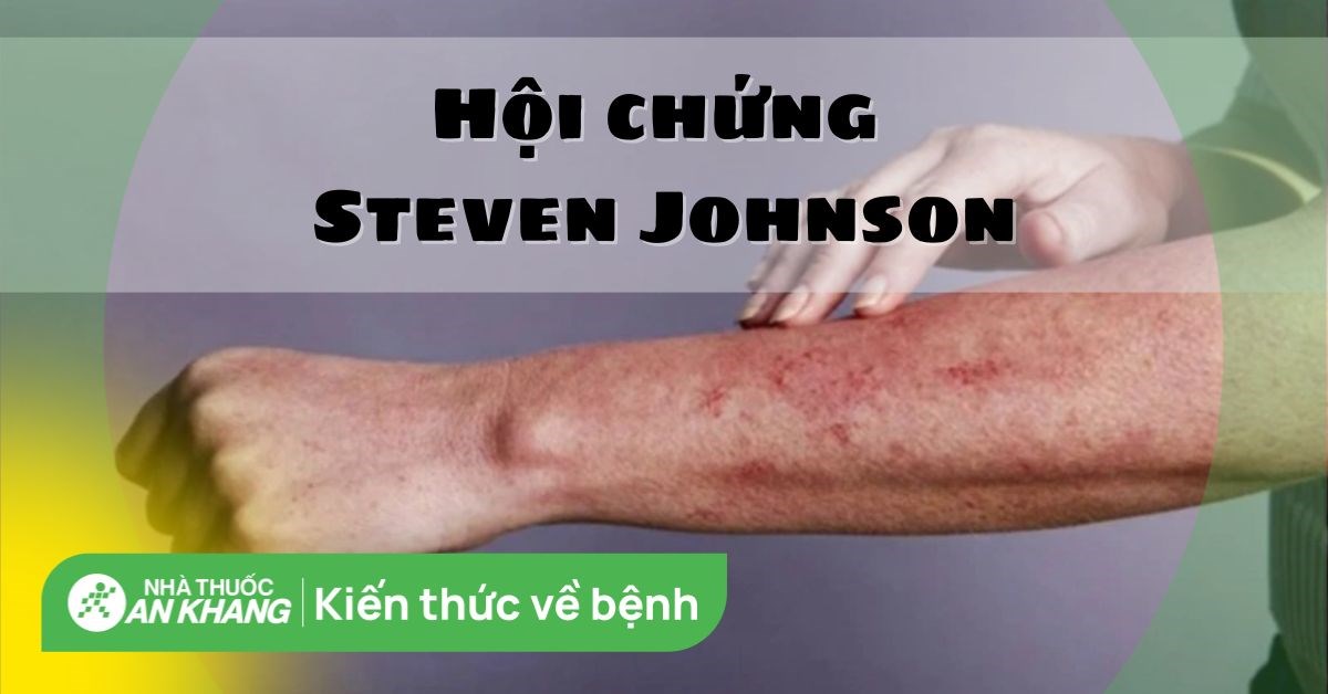 Hội chứng Steven Johnson: Nguyên nhân, dấu hiệu và cách xử trí