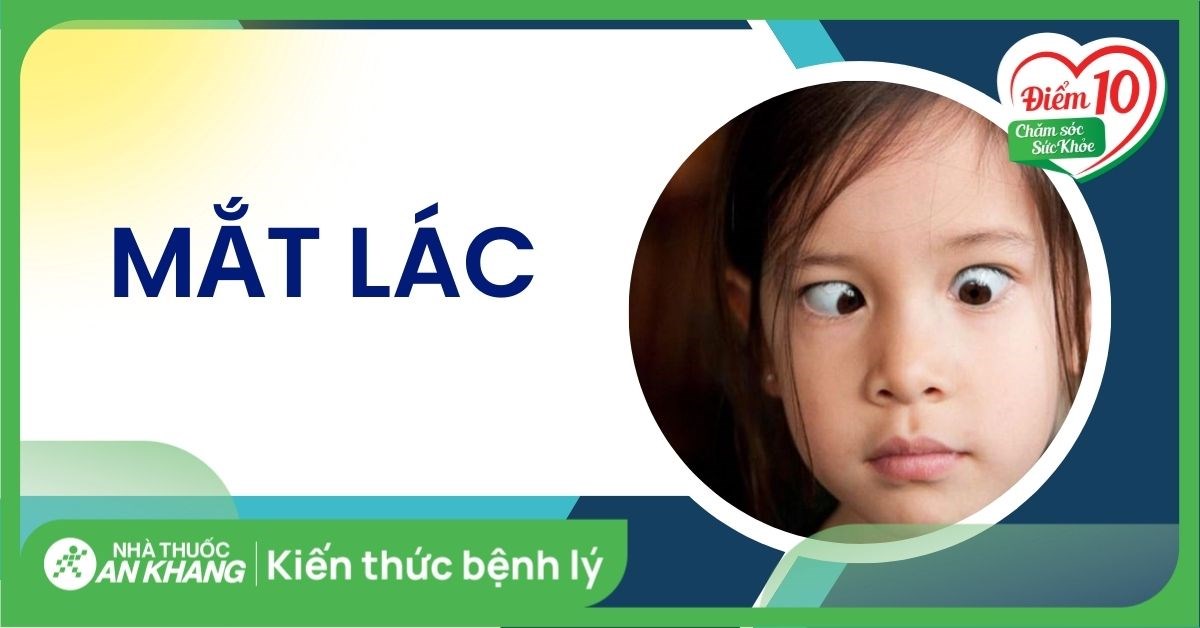 Mắt lác: Nguyên nhân, dấu hiệu và cách điều trị hiệu quả