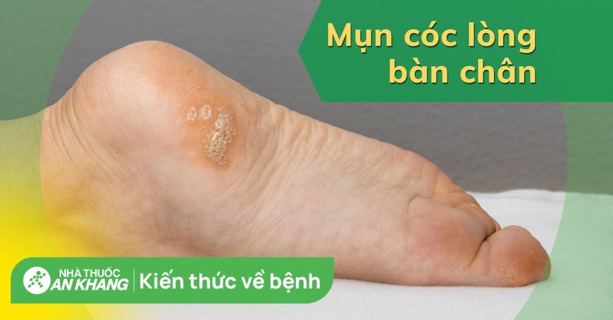 Mụn cóc lòng bàn chân: Nguyên nhân, điều trị và chăm sóc bàn chân