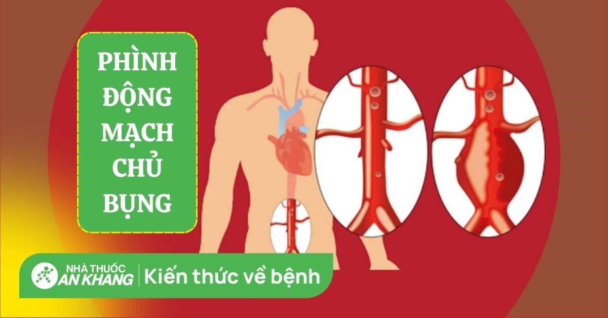 Phình động mạch chủ bụng và những điều bạn cần biết