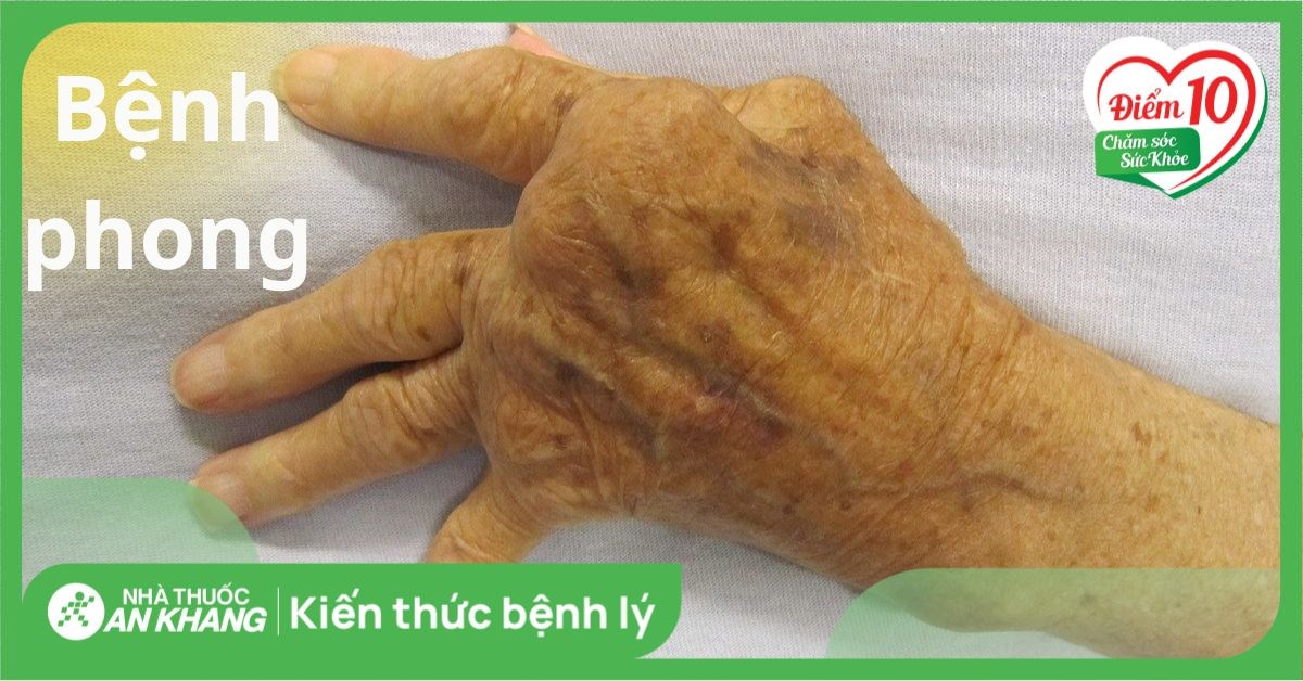 Bệnh phong: Nguyên nhân, triệu chứng và cách điều trị