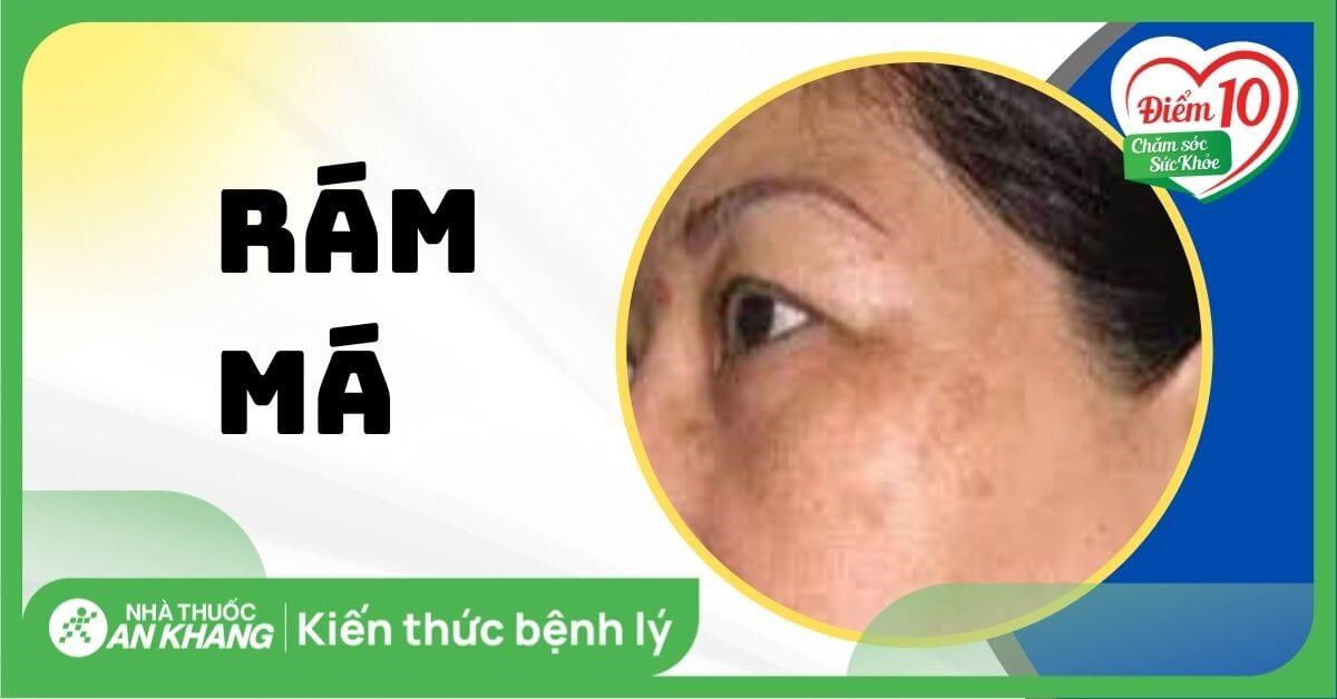 Rám má: Nguyên nhân, dấu hiệu và cách điều trị hiệu quả