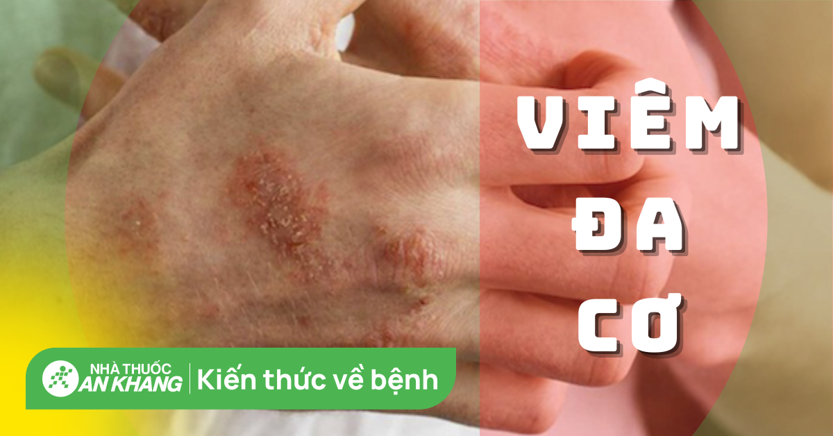 Viêm da cơ và viêm đa cơ: Nguyên nhân, dấu hiệu, biến chứng, điều trị