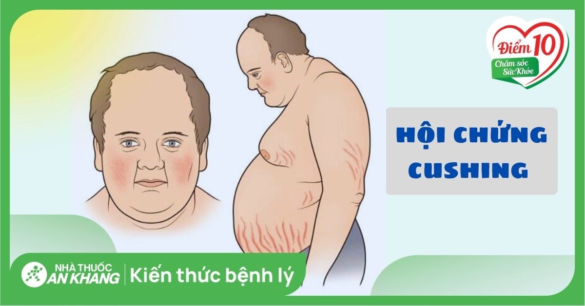 Hội chứng Cushing: Nguyên nhân, triệu chứng, cách điều trị