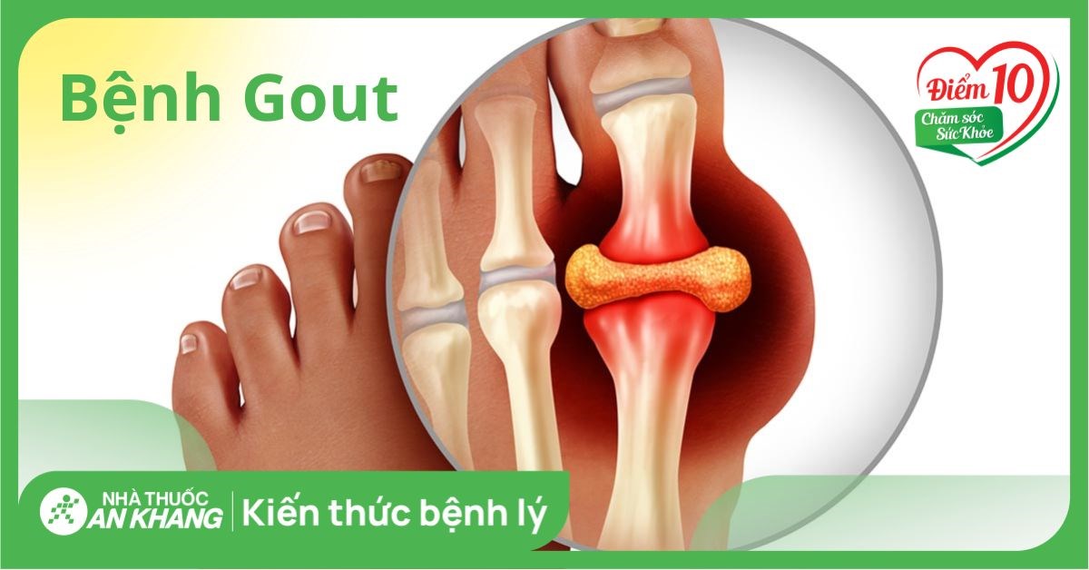 Bệnh gút (Gout): Nguyên nhân, triệu chứng, cách điều trị