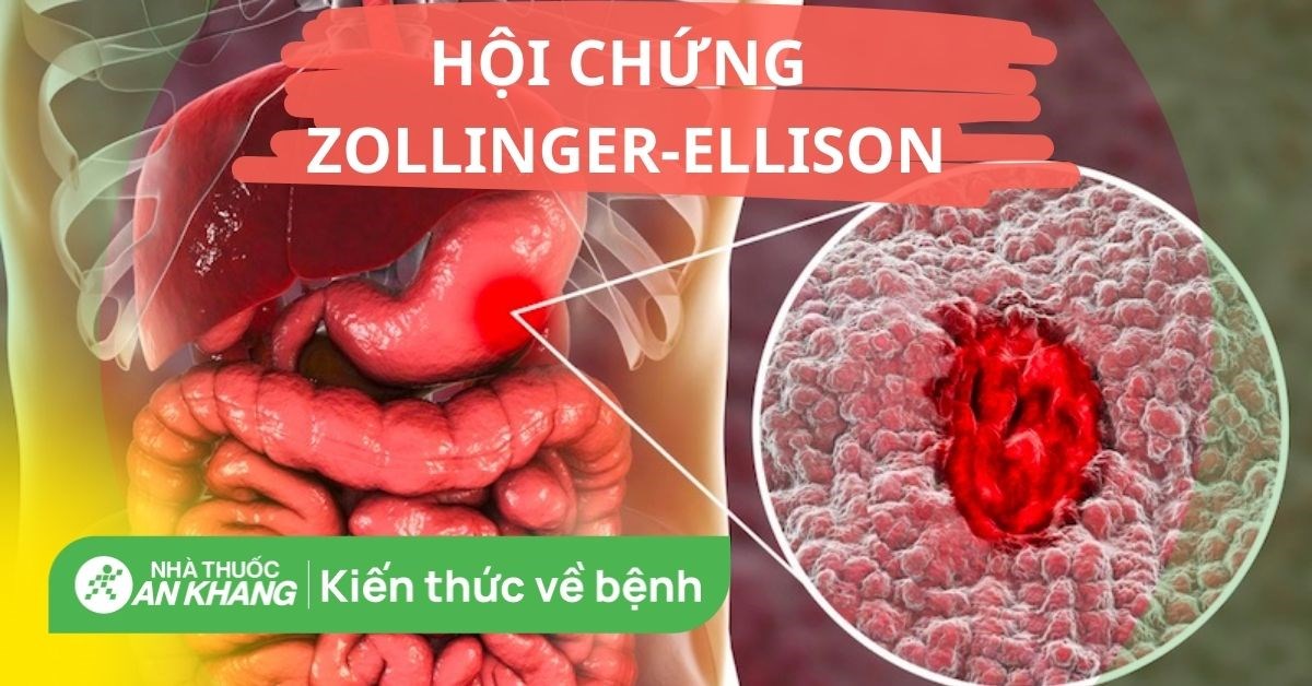 Hội chứng Zollinger-Ellison: Nguyên nhân, dấu hiệu và cách điều trị