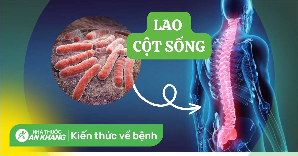 Lao cột sống (mục xương sống): Nguyên nhân và cách điều trị