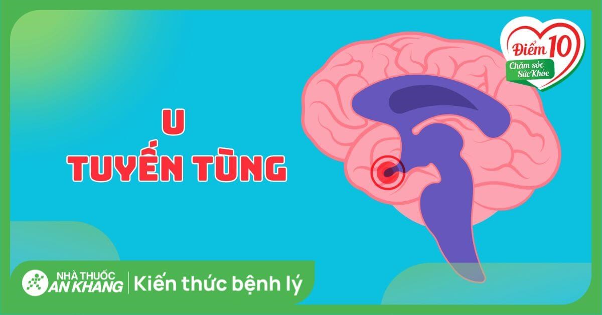 U tuyến tùng là gì? Triệu chứng, nguyên nhân và cách điều trị