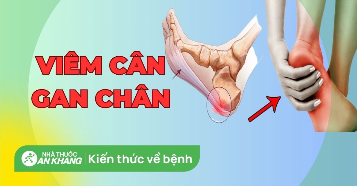 Viêm cân gan chân: Nguyên nhân, triệu chứng và cách điều trị