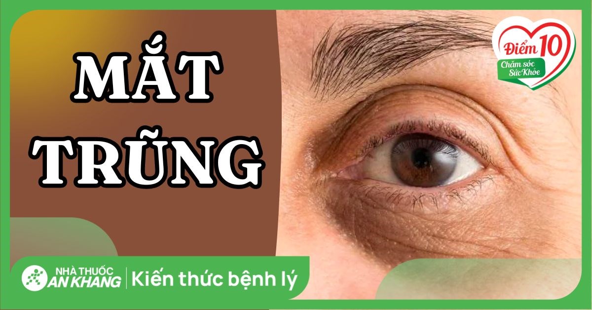 Mắt trũng là dấu hiệu cảnh báo bệnh lý nào? Dấu hiệu nhận biết